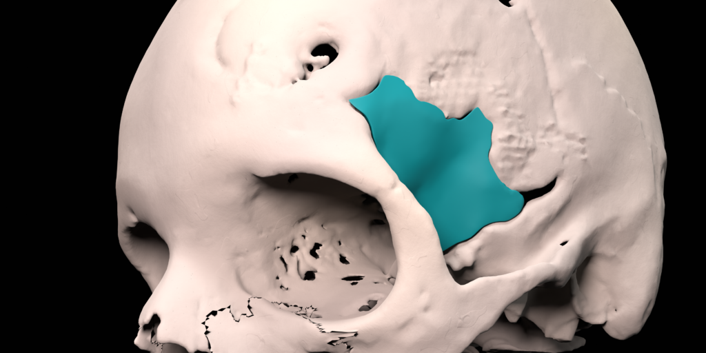 Spheno-Orbital Meningioma - 3D-Lab+ 3DLab-LUMC