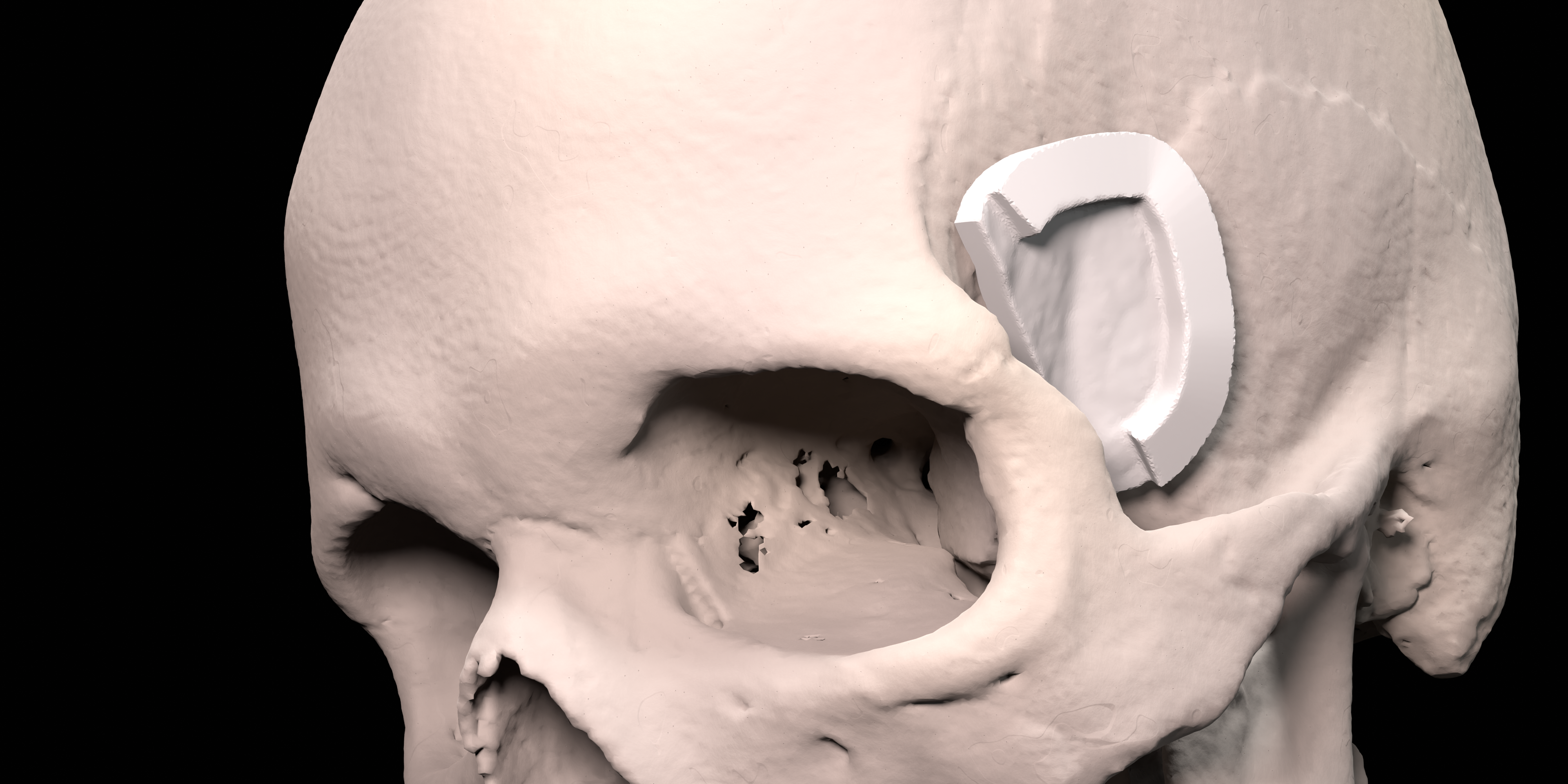 Spheno-orbitaal meningeoom - 3D-Lab+ 3DLab-LUMC