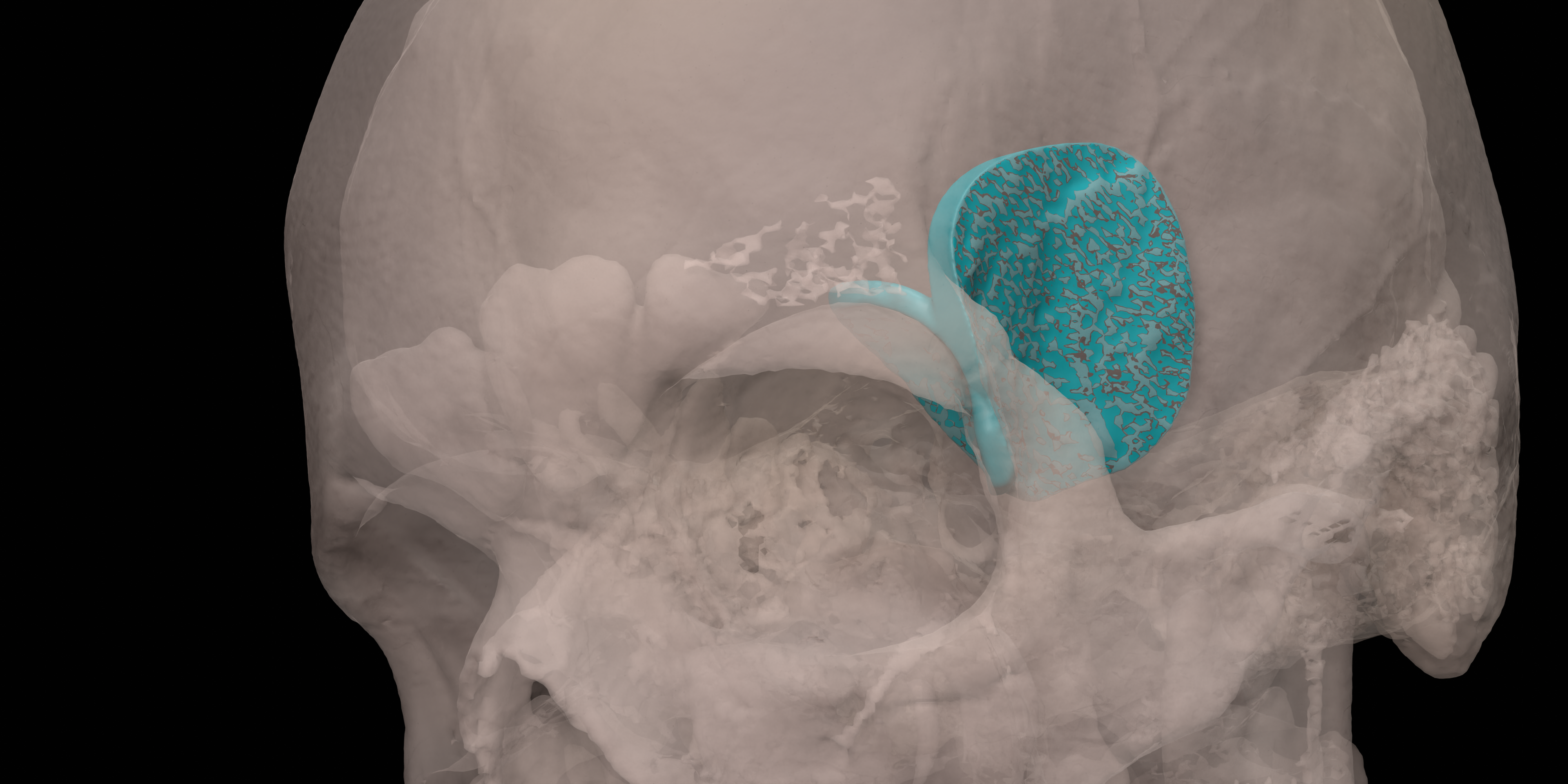 Spheno-orbitaal meningeoom - 3D-Lab+ 3DLab-LUMC