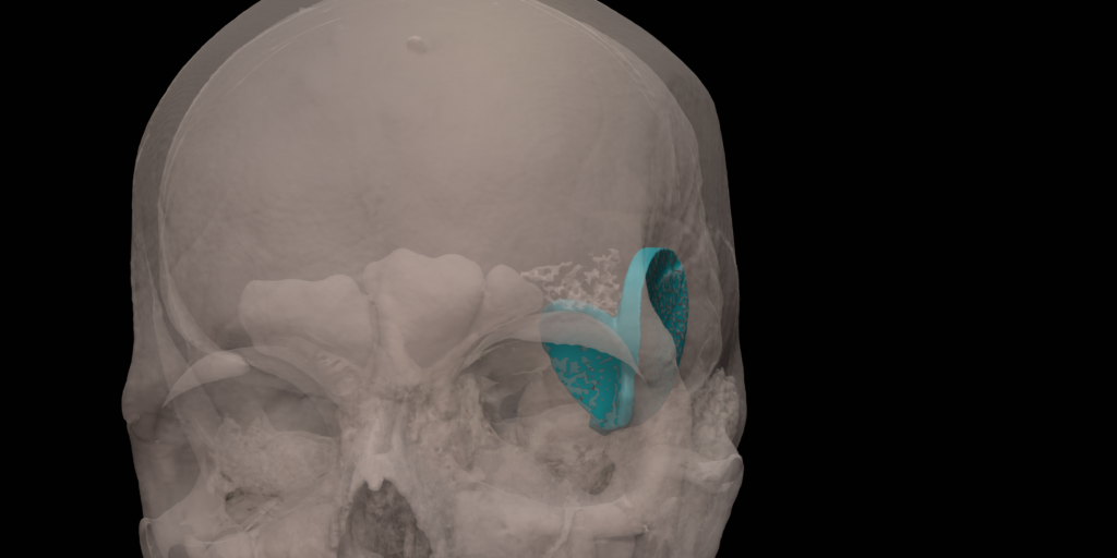 Spheno-orbitaal meningeoom - 3D-Lab+ 3DLab-LUMC