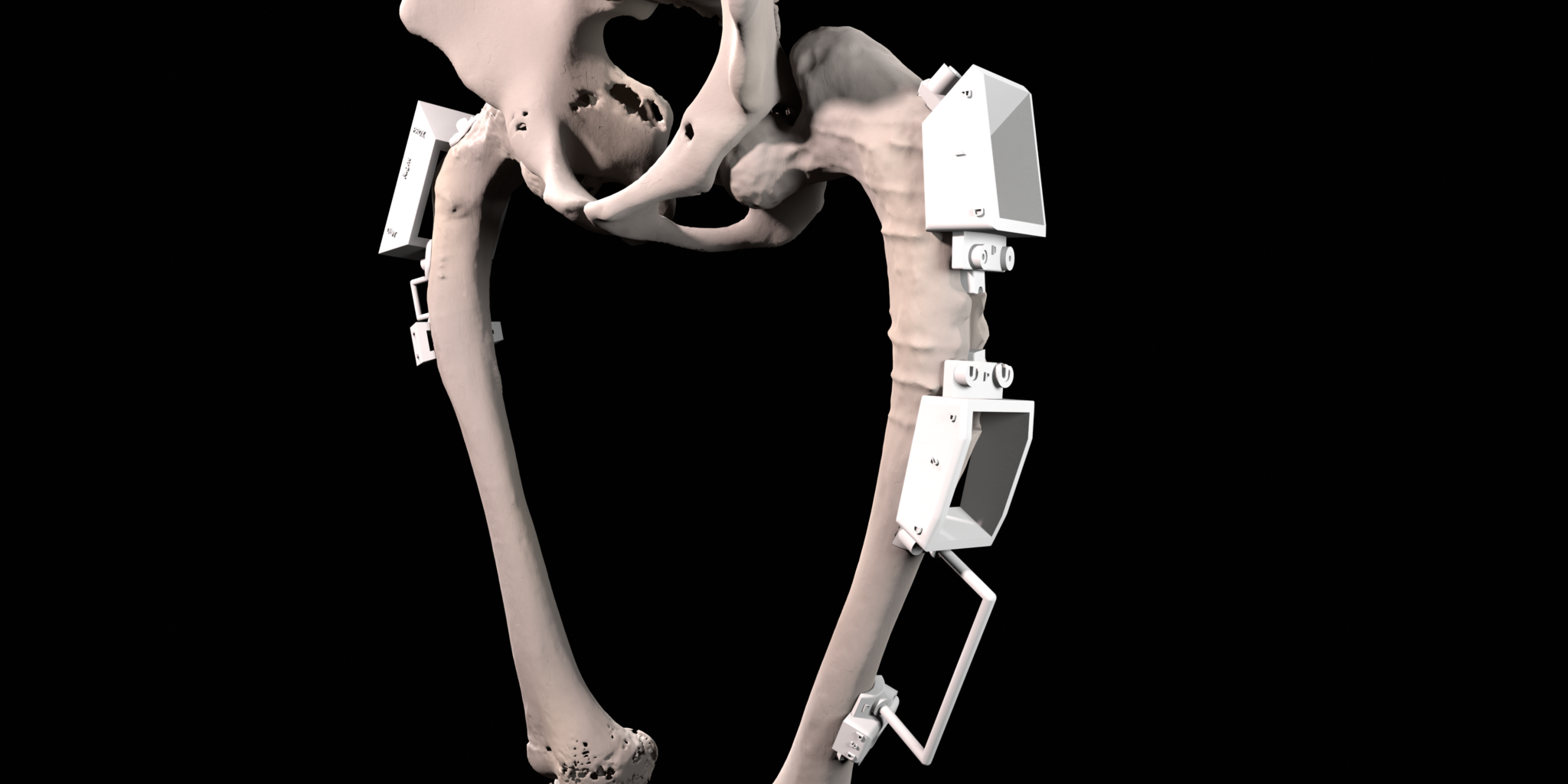 Femur correctie osteotomie - 3D-Lab+ 3DLab-LUMC