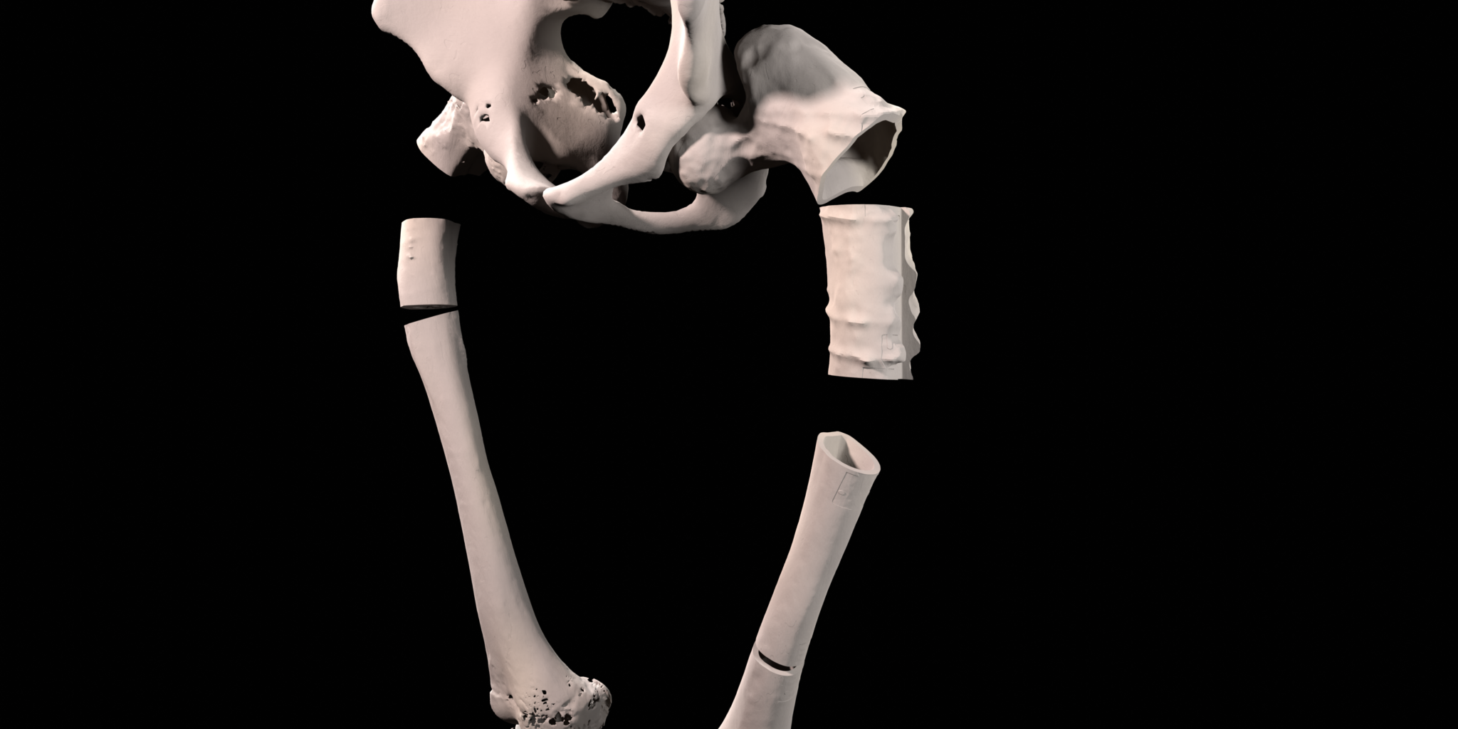 Full Femur Osteotomy - 3D-Lab+ 3DLab-LUMC