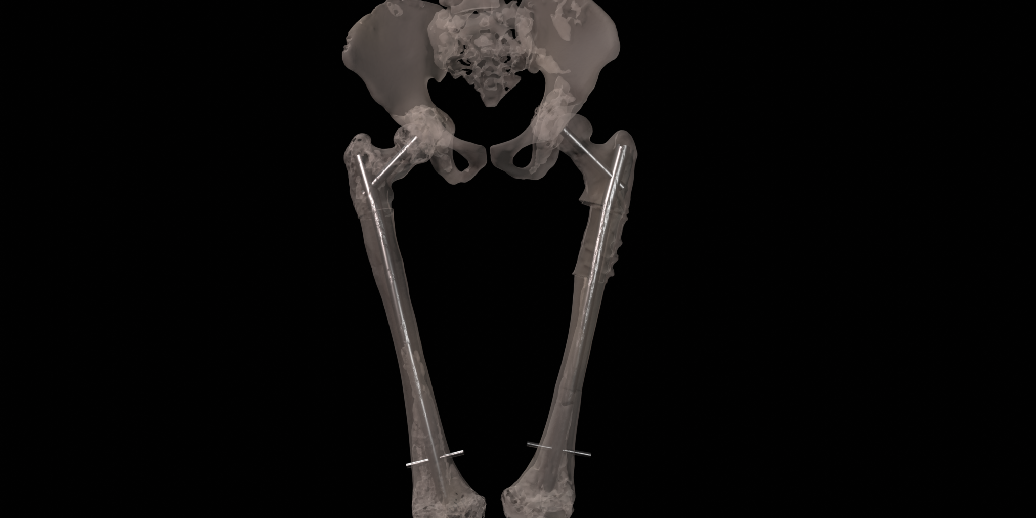 Full Femur Osteotomy - 3D-Lab+ 3DLab-LUMC