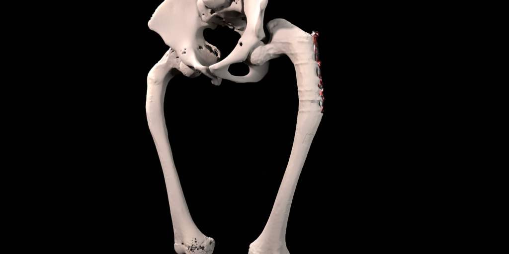 Femur correctie osteotomie - 3D-Lab+ 3DLab-LUMC