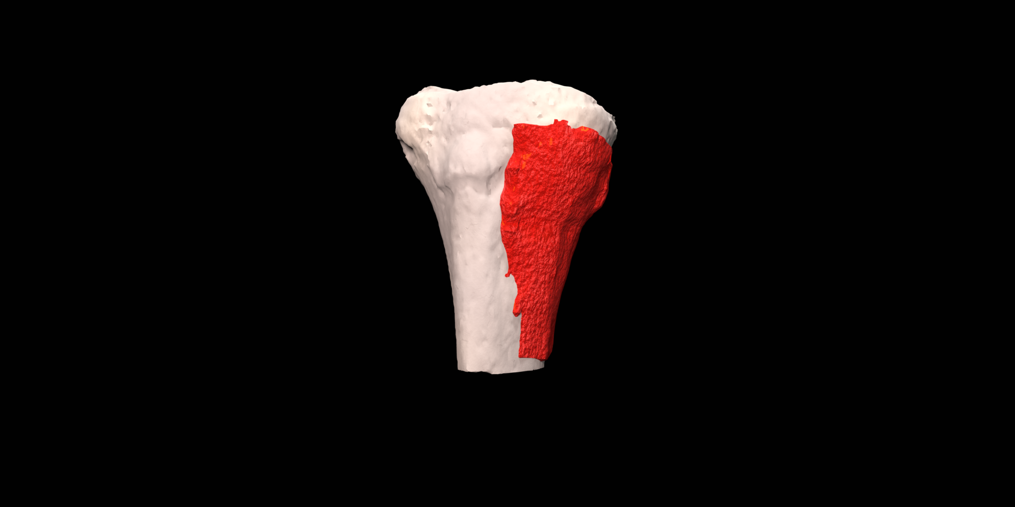 Allograft Reconstruction - 3D-Lab+ 3DLab-LUMC