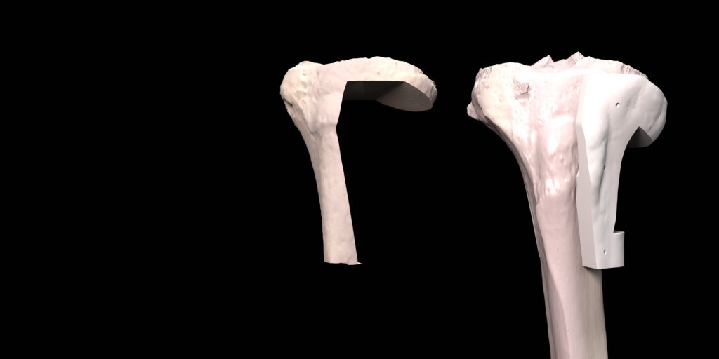 Allograft Reconstruction - 3D-Lab+ 3DLab-LUMC