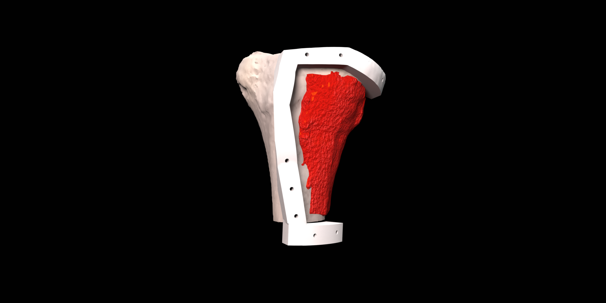 Allograft Reconstruction - 3D-Lab+ 3DLab-LUMC
