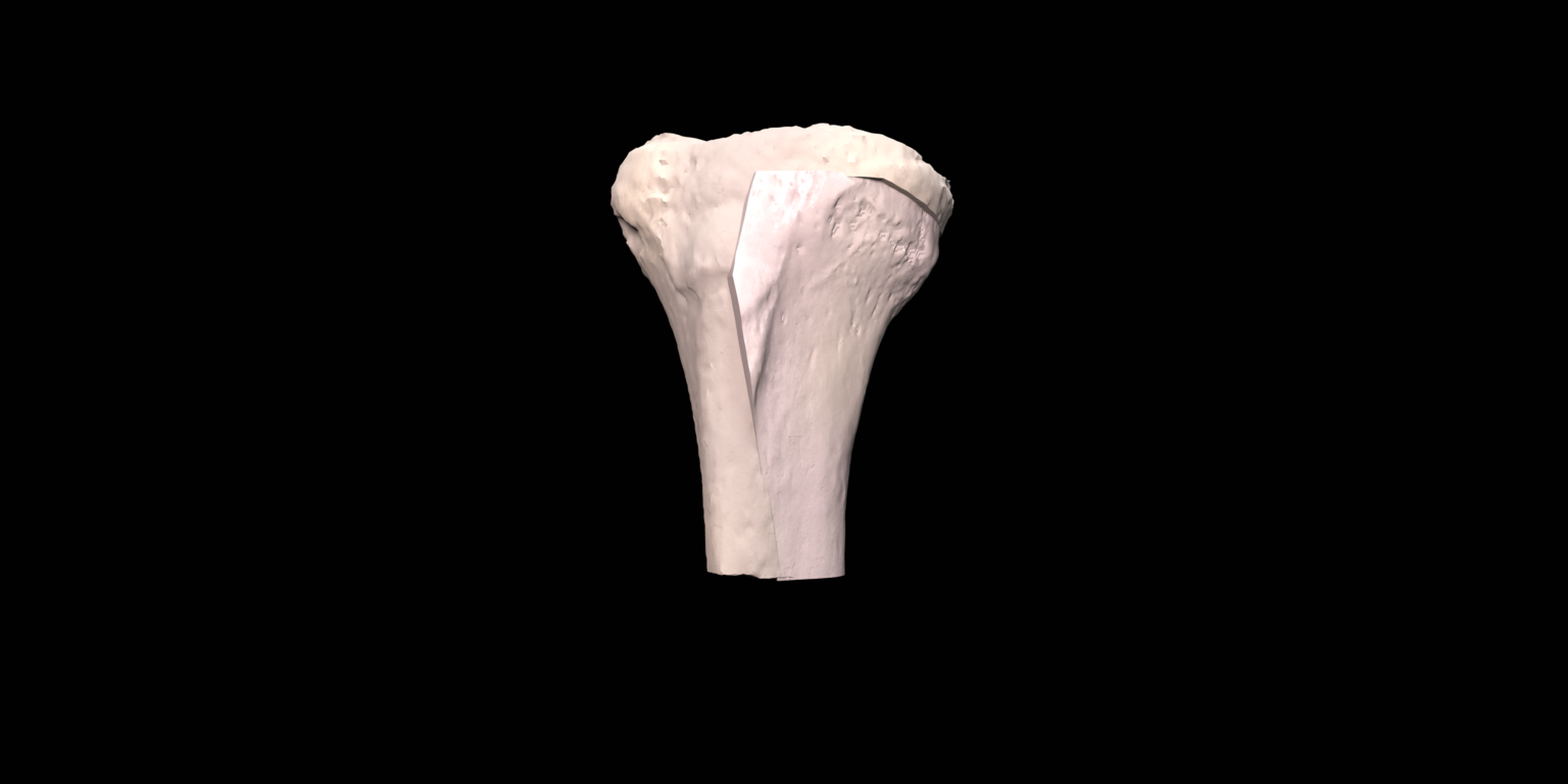 Allograft Reconstruction - 3D-Lab+ 3DLab-LUMC