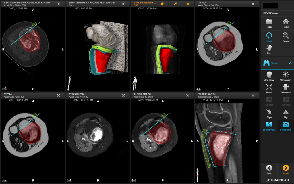 Allograft Reconstruction - 3D-Lab+ 3DLab-LUMC