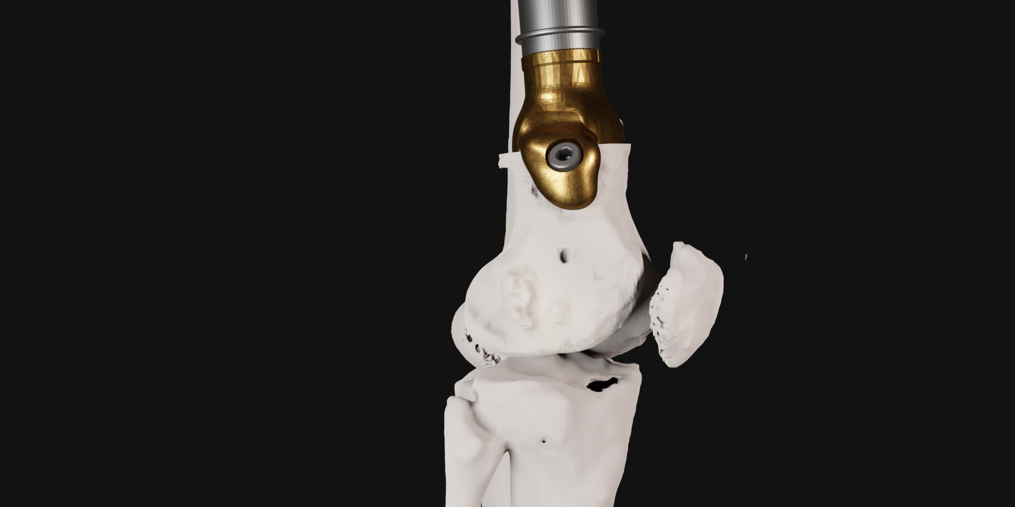 Patient specific 3D printed implants - 3D-Lab+