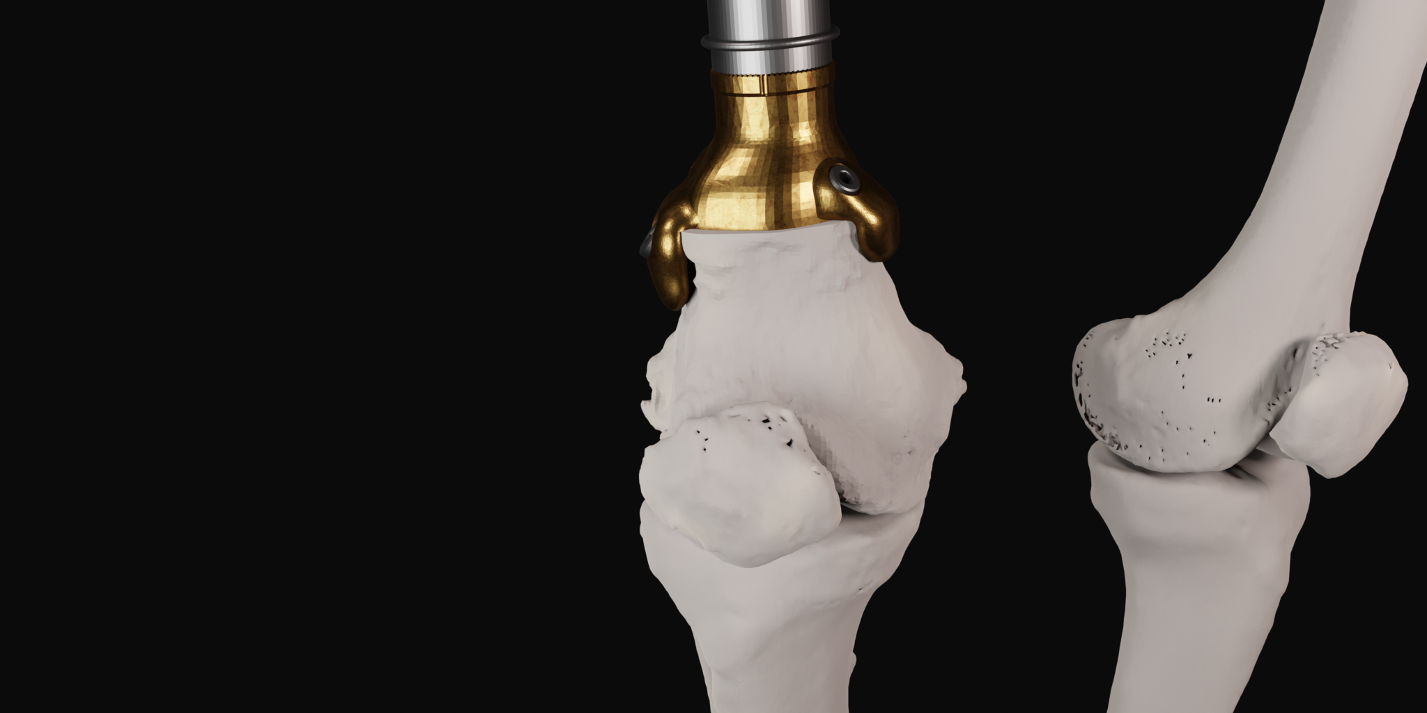Patient specific 3D printed implants - 3D-Lab+ 3DLab-LUMC